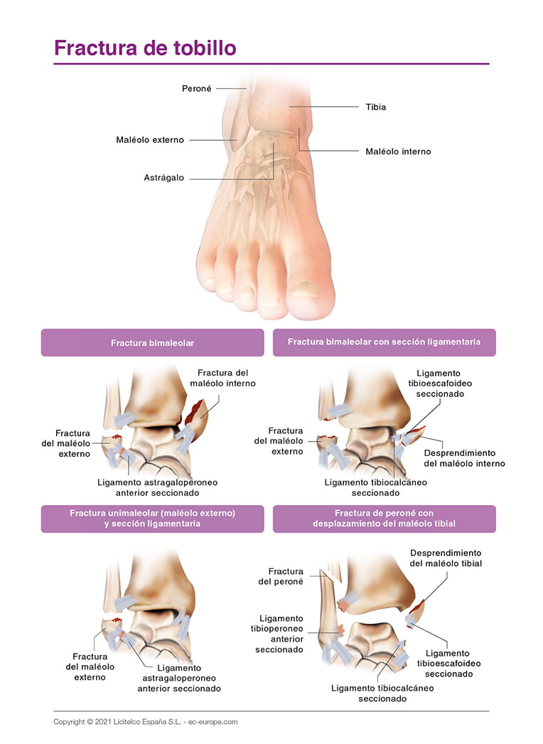 Tipos De Fracturas De Peroné En El Tratamiento De Las Fracturas De